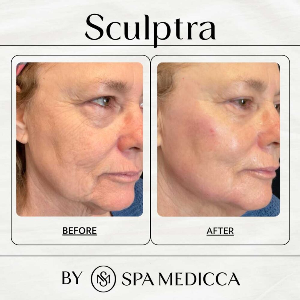 Dermal Fillers in Centerville & Mason, OH | Spa Medicca